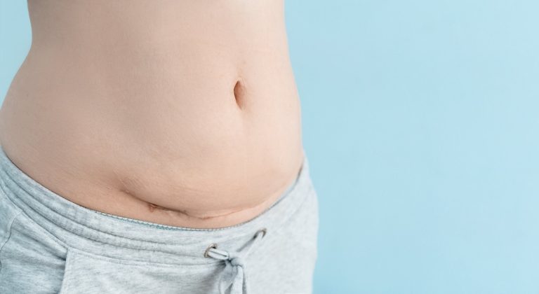 How to Get Rid of C-Section Overhang? 6 Effective Ways